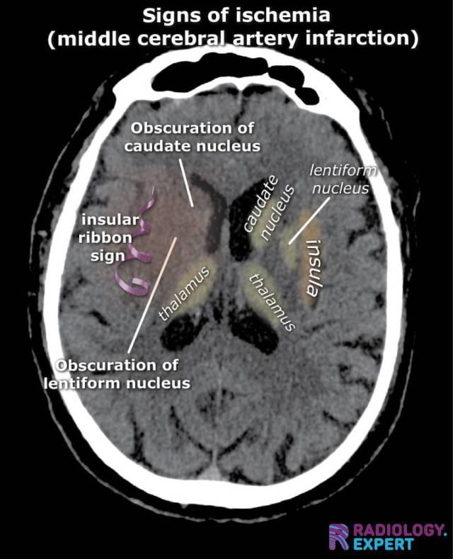Interventional Radiology - The Stroke Patient